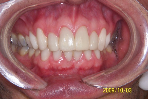 High showing gums - perlinlokedentalsurgery